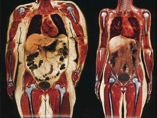 8 Surprising Effects of Obesity On Your Body - HFR